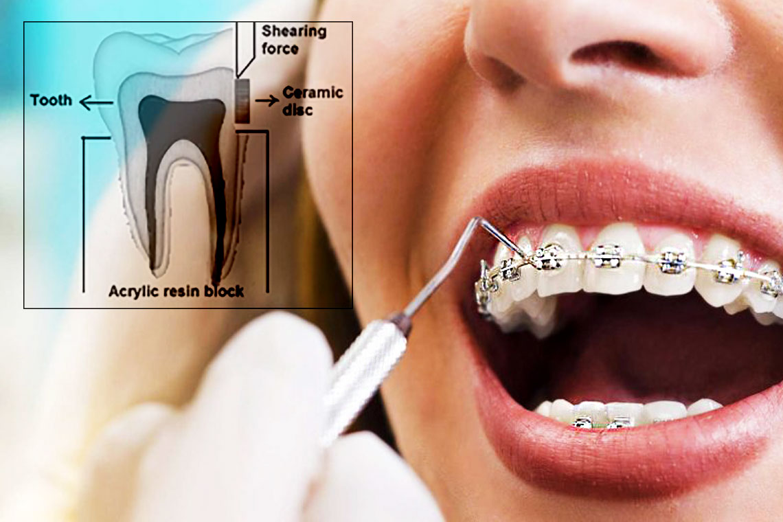 Comparison of wire loop and shear orthodontic - دکتر نوروزی | متخصص ...