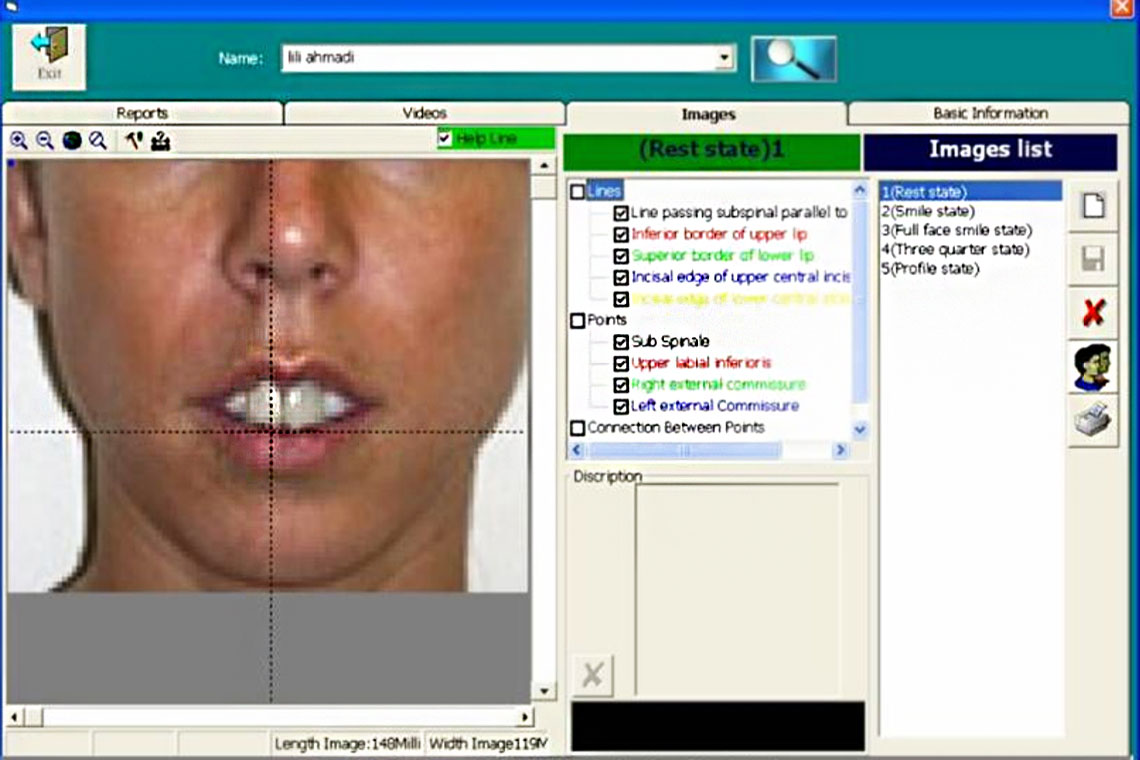 Software design for smile analysis - دکتر نوروزی | متخصص ارتودنسی